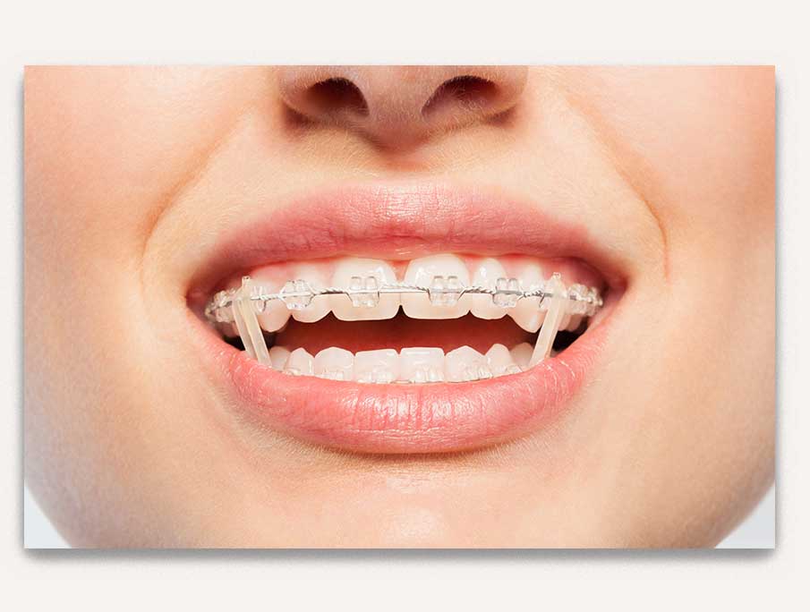 Rings - Beyond Smile